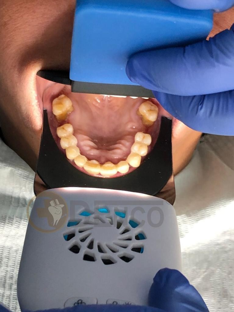 آینه عکاسی دندانپزشکی Denco - نوتریدنت